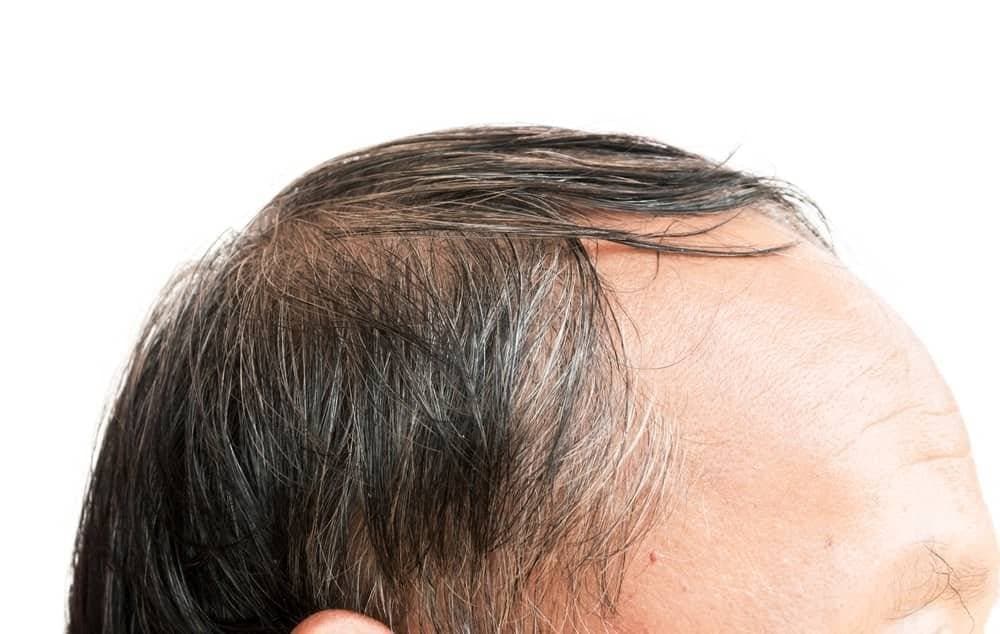 The Comb Over Vs Other Balding Styles [Photo Comparisons]